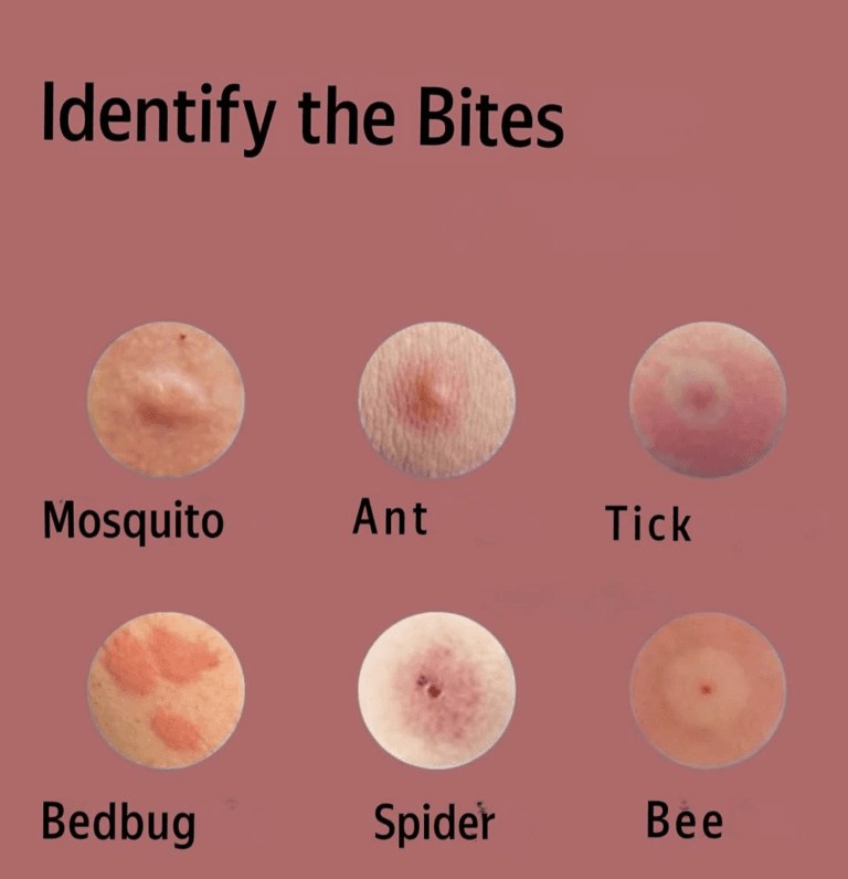 What Bit Me? How to Identify Common Bug Bites - Cooking At Home